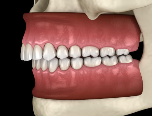 teeth overlap skeletal overbite - BellevueRX
